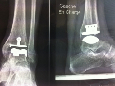 Prothèse totale de cheville - Union Cheville Pied