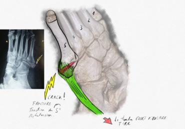 Fracture base cinquième métatarsien - Union Cheville Pied