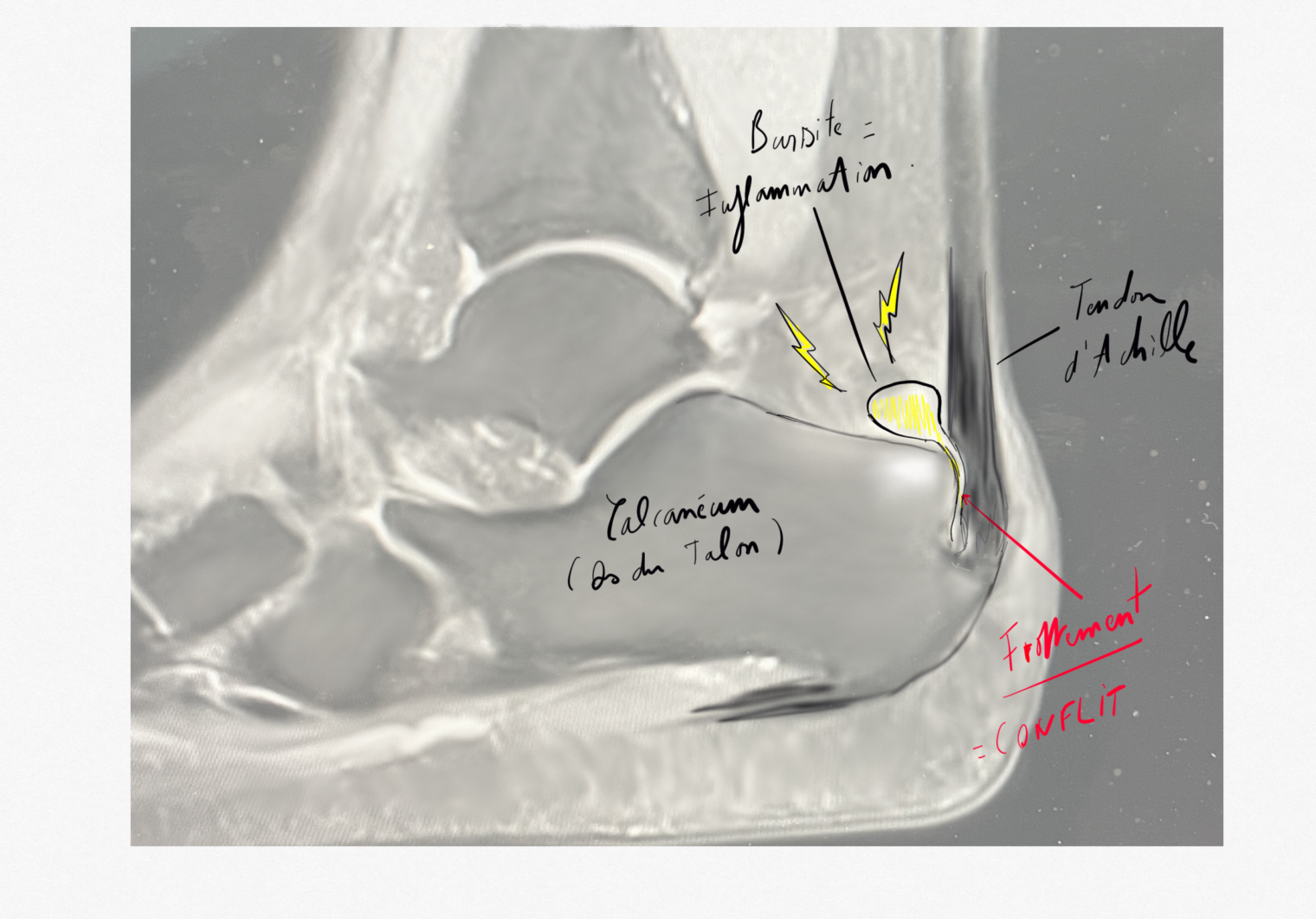 Syndrome de Haglund - Union Cheville Pied