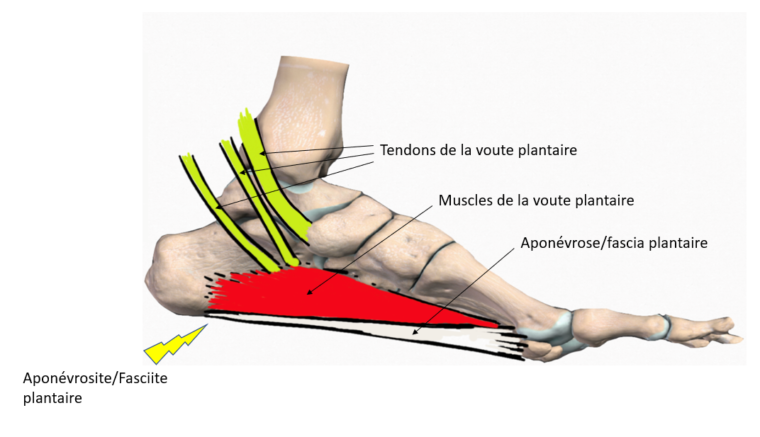 Aponévrosite plantaire - Union Cheville Pied