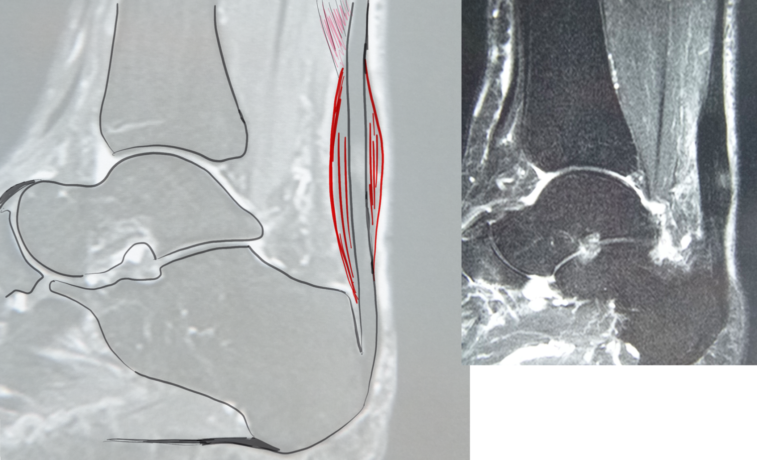 Tendon d'Achille - Union Cheville Pied