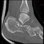 Arthrose sous-talienne - Union Cheville Pied