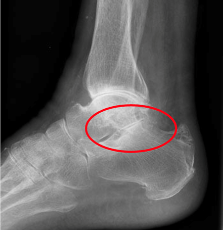 Arthrose sous-talienne - Union Cheville Pied