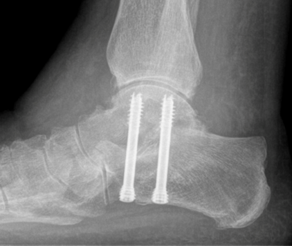 Arthrose sous-talienne - Union Cheville Pied