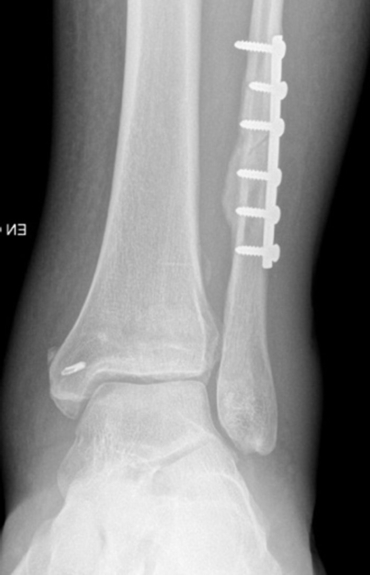 Fractures de la Cheville ou Malléole - Union Cheville Pied