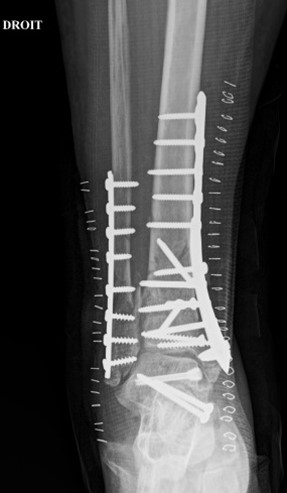Fractures de la Cheville ou Malléole - Union Cheville Pied